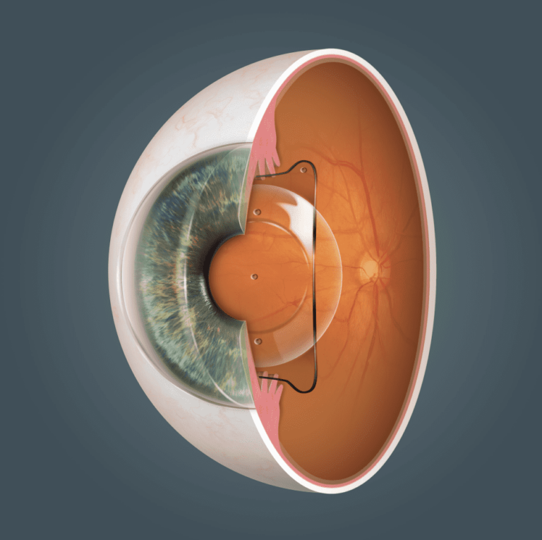 Implantable Contact Lens in Singapore (2026): Benefits, Side Effects ...