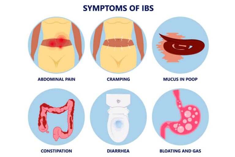 Irritable Bowel Syndrome (IBS): Causes, Symptoms and Treatment in ...