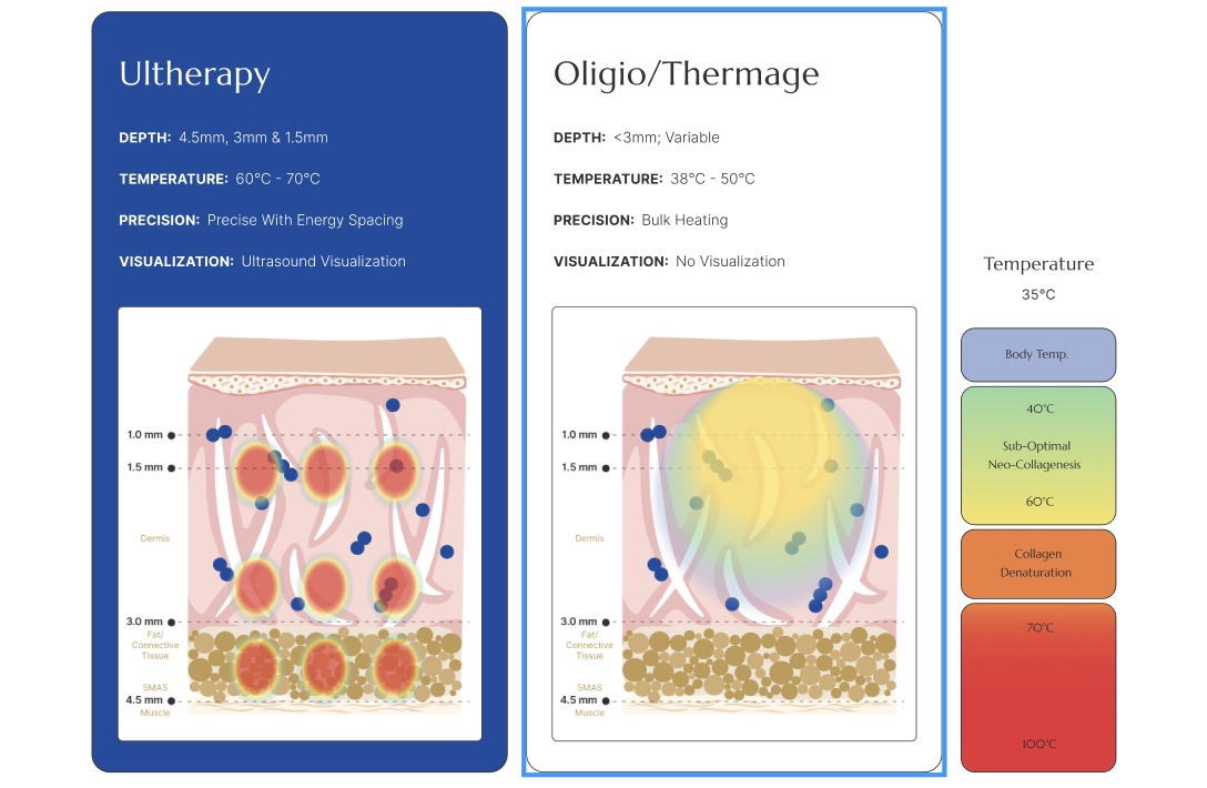 Oligio Skin Tightening: Revolutionary K-Lifting Technology - Urban Living