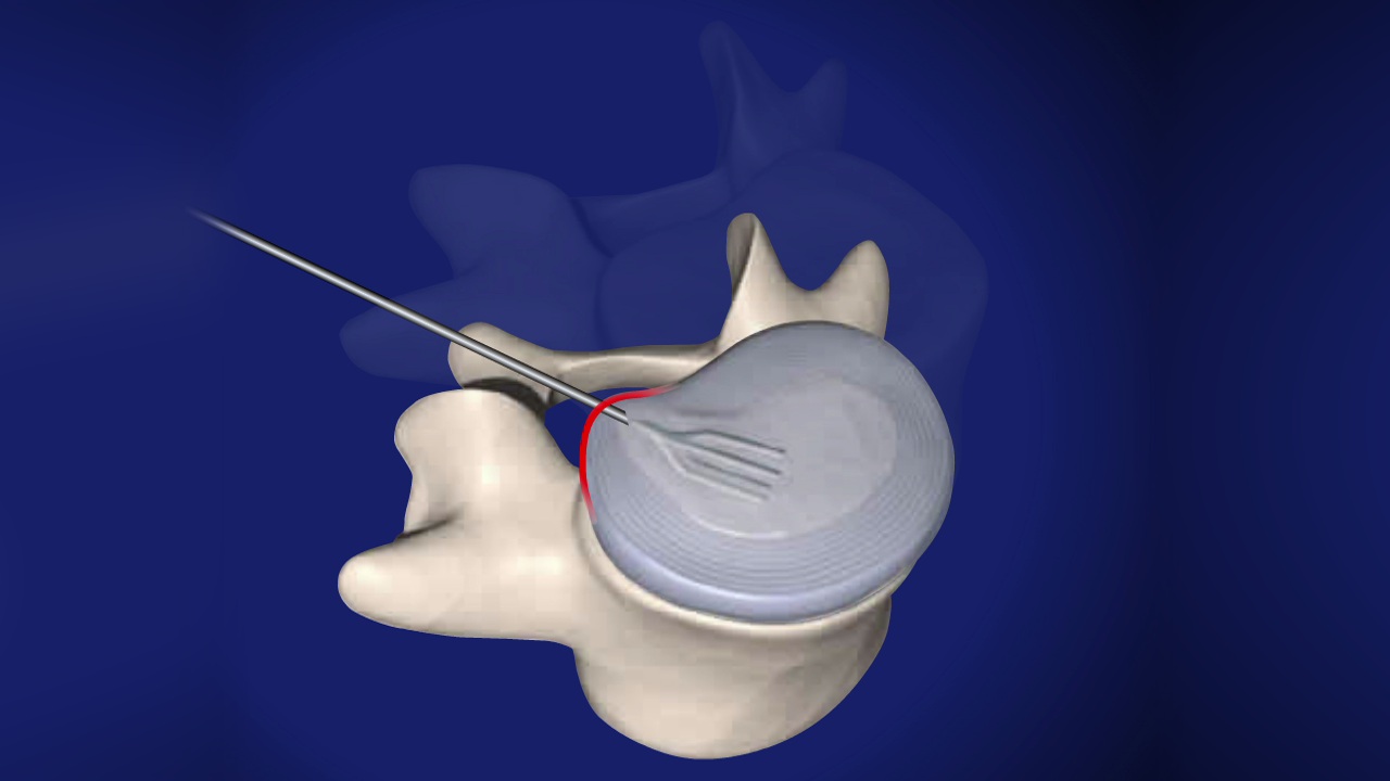 Slipped Disc Treatment in Singapore: Causes, Risks, Cost - Urban Living